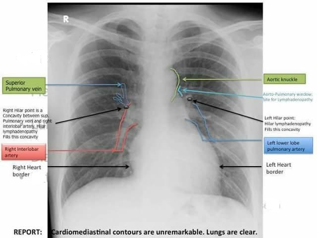 Heart Borders Chest X Ray