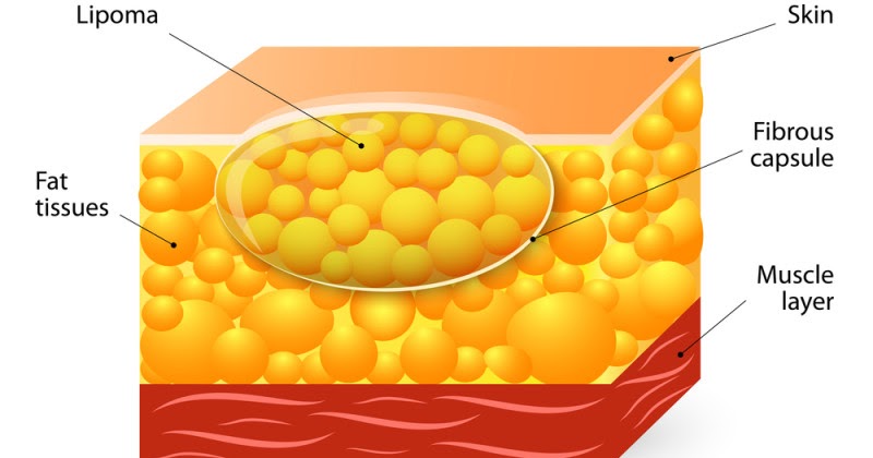 Multiple Lipoma Removal