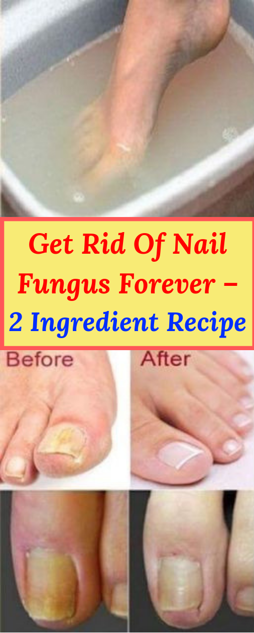 Herbal Medicine Get Rid Of Nail Fungus Forever 2 Ingredient Recipe