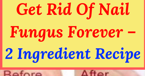 Herbal Medicine Get Rid Of Nail Fungus Forever 2 Ingredient Recipe