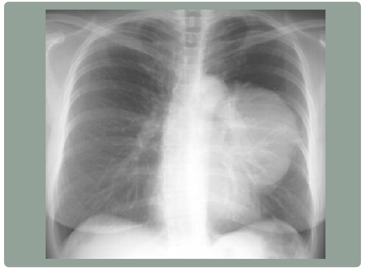 Chest Medicine Made Easy-Dr Deepu: HIlum Overlay Sign