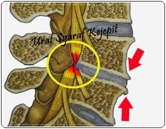 Tentang Penyakit: Urat Syaraf Kejepit