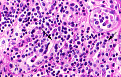 Nefritis intersticial; Nefritis Tubulointersticial