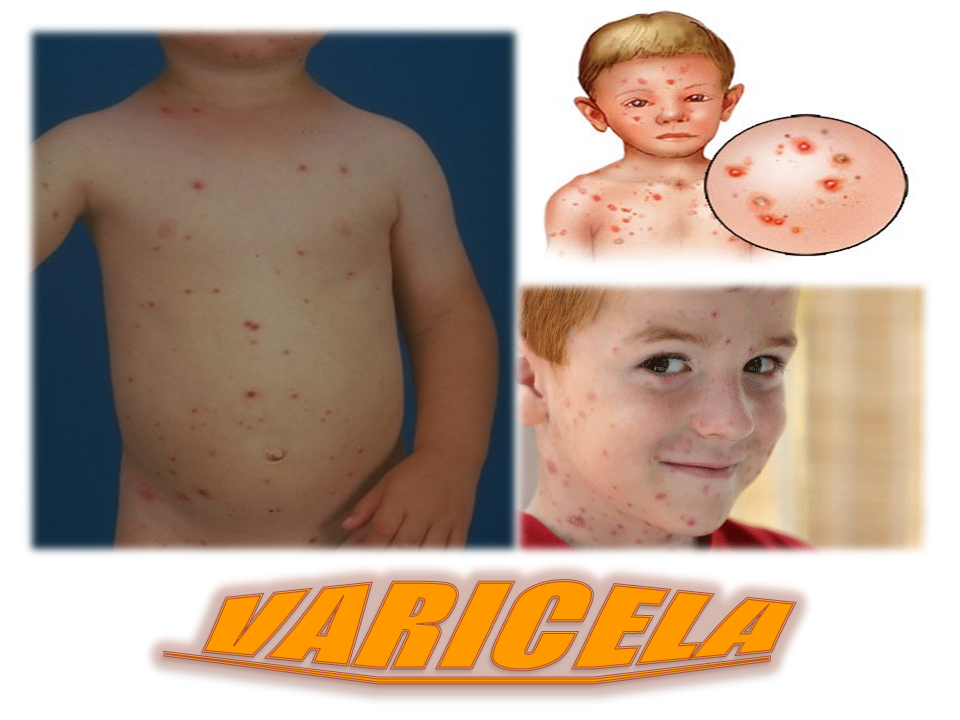 VARICELA : DIAPOSITIVAS DE VARICELA