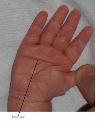 palmistry: Know your Future: Simian lines on a palm