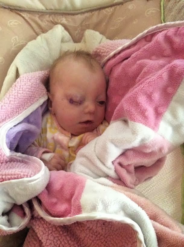 The Nelsons: Baby Christina's Recent Surgeries: Eyes & G-tube