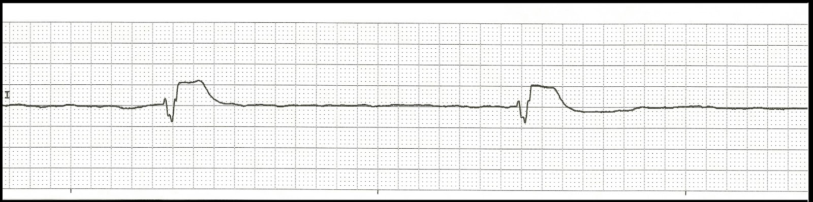 Practice EKG Rhythm Strips 95
