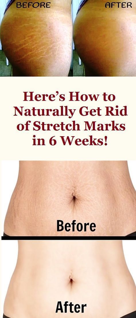 How To Get Rid Of Stretch Marks In A Week Wellness Hots