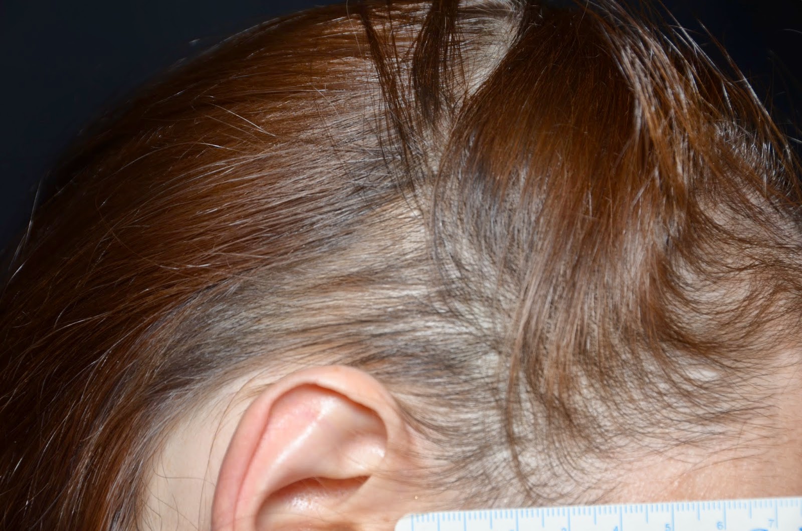 Konsultacijos: Lizdinė alopecija (lizdinis plikimas, alopecia areata)