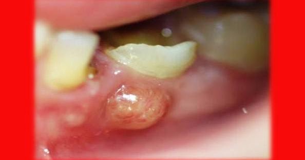 Abses Gigi : Definisi, Penyebab dan Gambaran Klinis - Mitra Kesmas