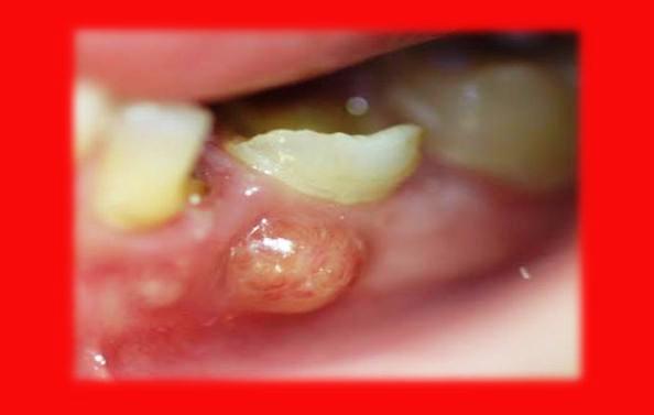 Abses Gigi : Definisi, Penyebab dan Gambaran Klinis