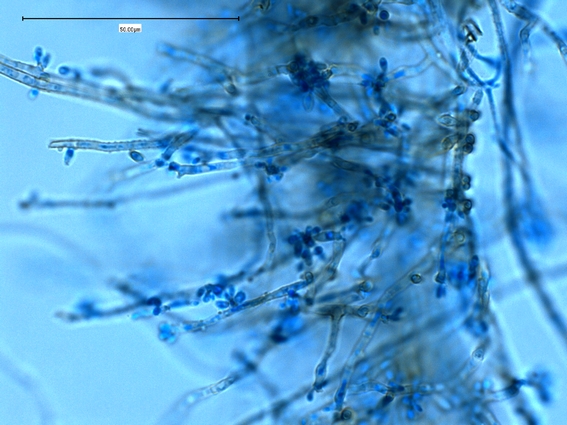 Fun With Microbiology (What's Buggin' You?): Fonsecaea pedrosoi/monophora