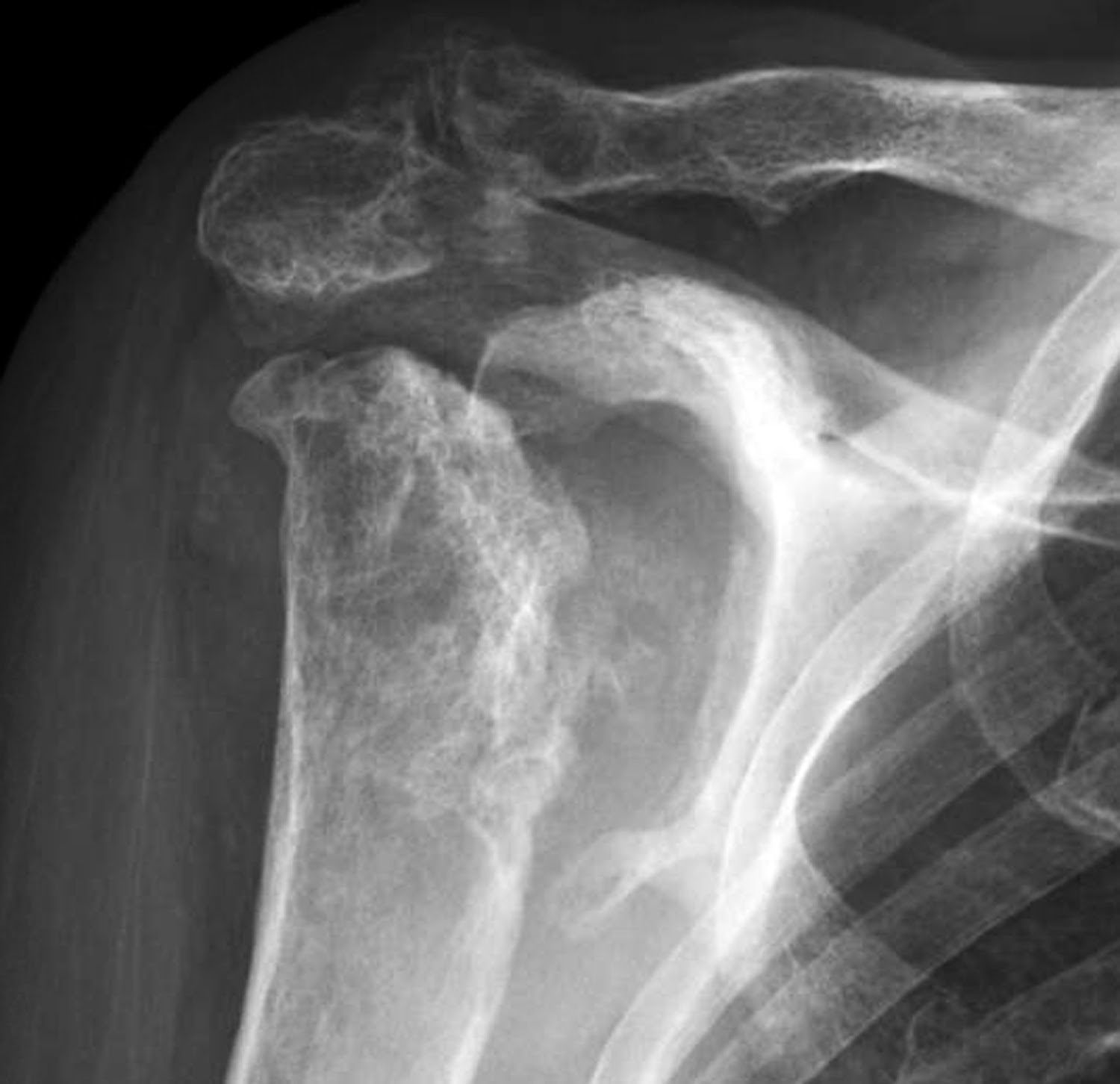 UW Shoulder and Elbow Academy: Shoulder joint replacement - many ...
