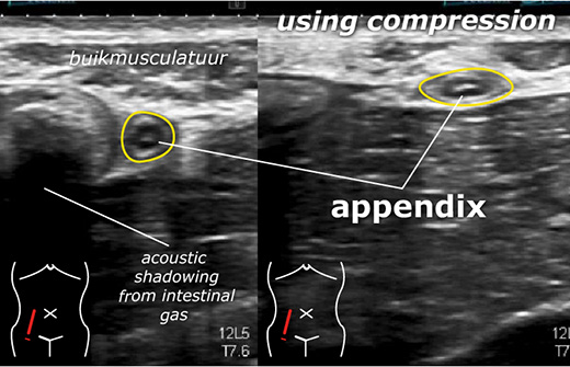 CamRadTech: Ultrasound Intestines