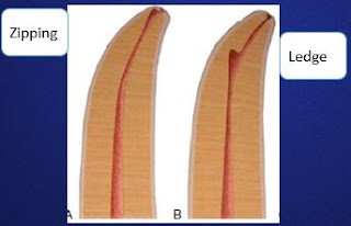 What is Ledge, Zipping, Strip Perforation and Apical Transportation in ...