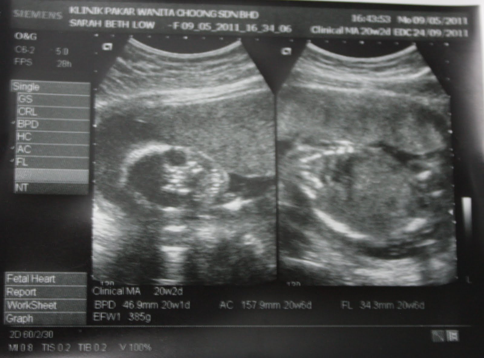 Baby Journal 2011: The 20 Week Scan & Pregnancy Highlights