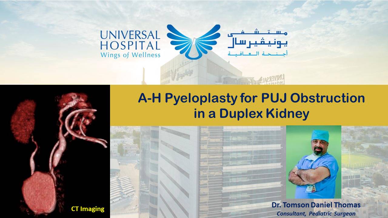 Successful A-H Pyeloplasty for PUJ Obstruction in a Duplex Kidney - Dr ...