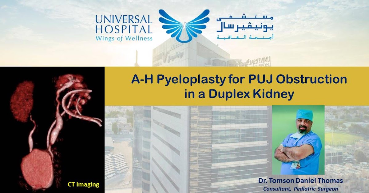 Successful A-H Pyeloplasty for PUJ Obstruction in a Duplex Kidney - Dr ...