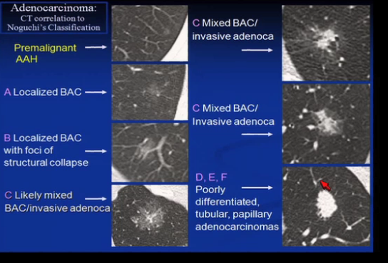 rsna: GGO lung nodule guideline