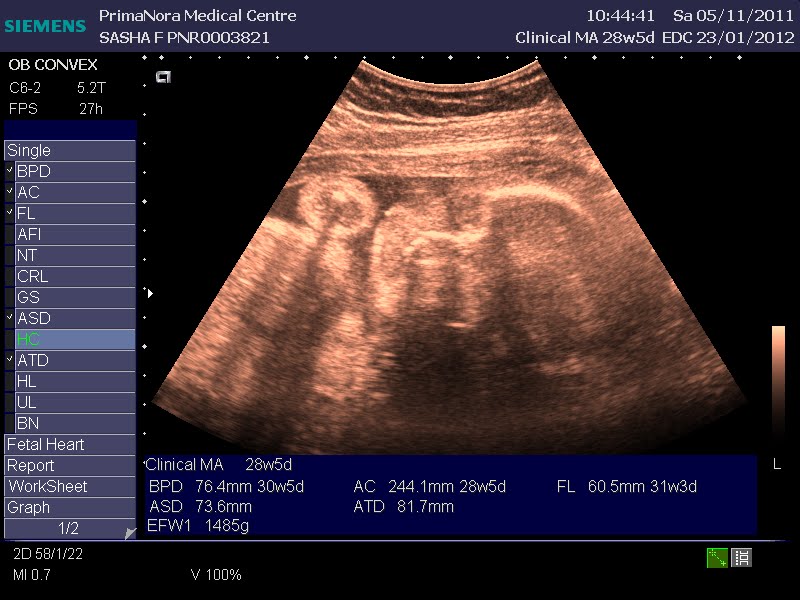 Sasha Bashir: actual baby scan