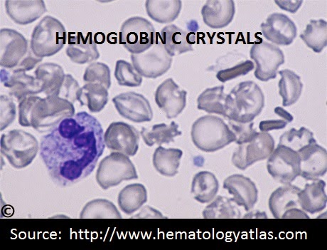 Lab Atlas: Hemoglobin C Crystals