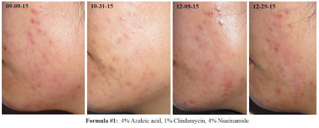Review: Curology (formerly Pocketderm)
