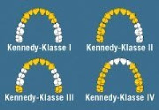 RPD 부분틀니 디자인 kennedy class 1 후방연장 국소의치 ~ Healthy Happy