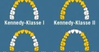 RPD 부분틀니 디자인 kennedy class 1 후방연장 국소의치 ~ Healthy Happy