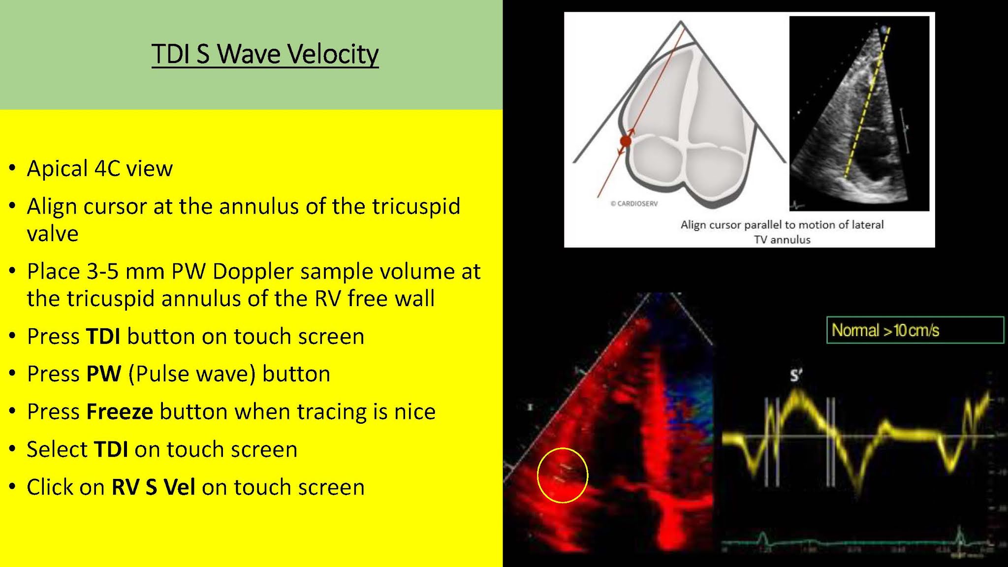 CVT Mohd Farid: Basic Echo Measurements And Values Nurain Jurnalis CVS Medical Part II