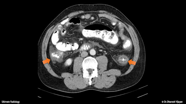 Ultimate Radiology : Eosinophilic Gastroenteritis