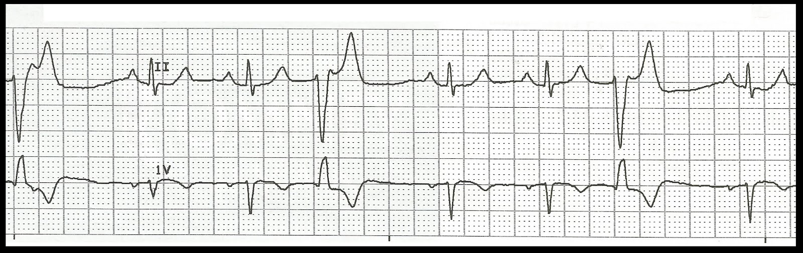 Practice EKG Rhythm Strips 162