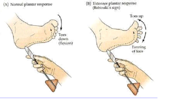 học Y: phản xạ Babinski