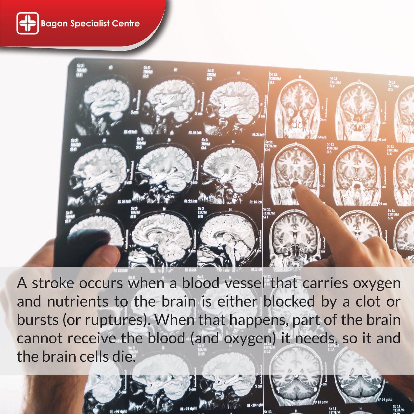 National Cancer Society of Malaysia, Penang Branch: Fast Facts About Stroke