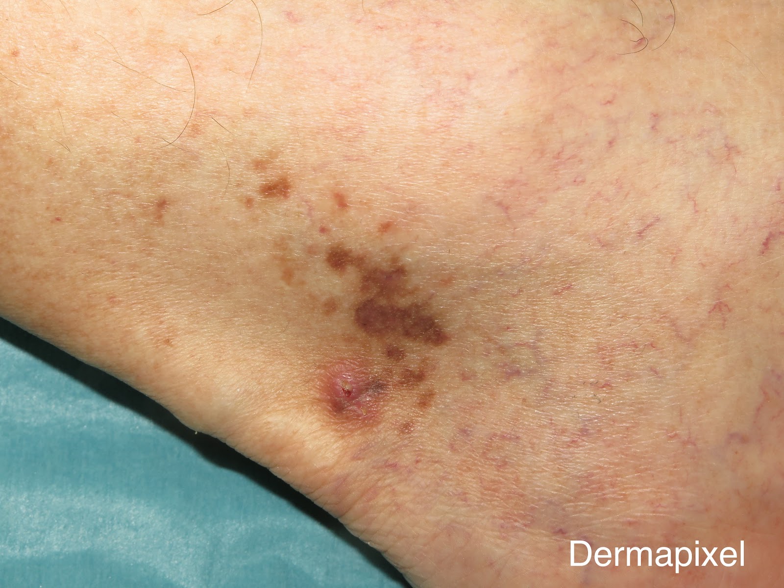 Dermapixel: junio 2018