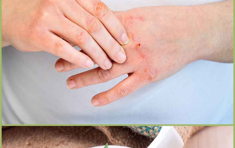 Remèdes à la maison pour la dermatite : comment soulager les symptômes ...