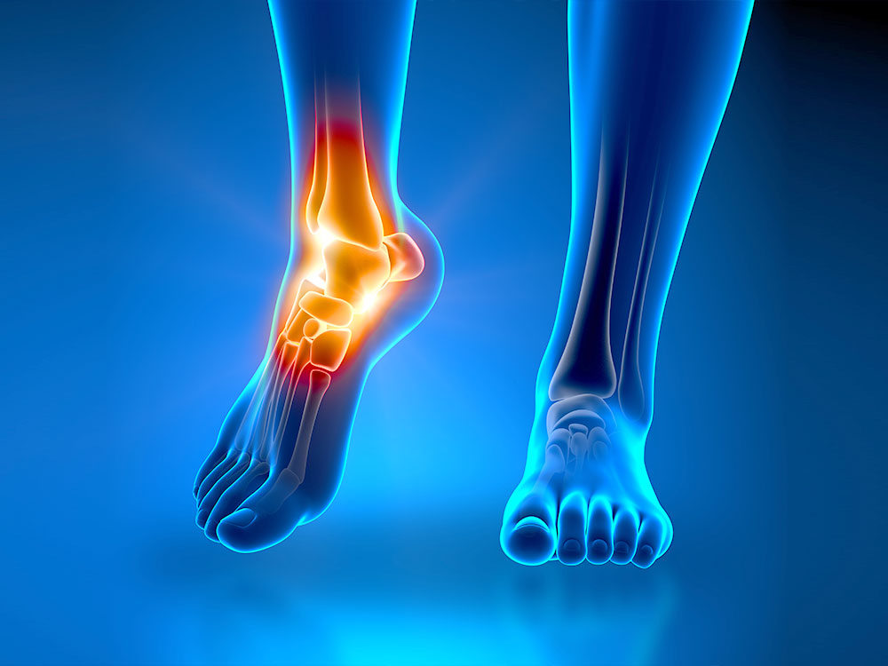 SIMPLESMENTE CURANDO: COMO MELHORAR OS SINTOMAS DA GOTA