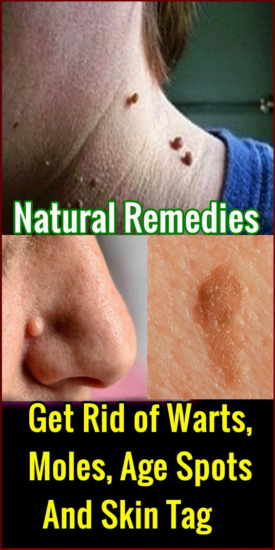How To Get Rid of Warts, Moles, Age Spots And Skin Tag