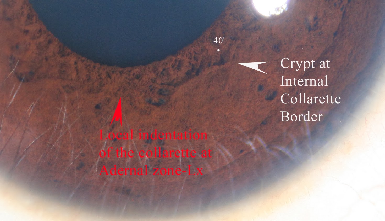 Modern & Multidimensional Iridology: Signs at Internal Collarette ...