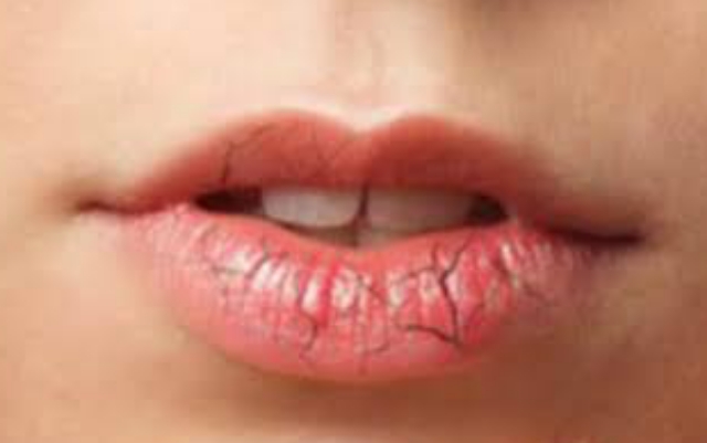 7 Penyebab Dan Cara Mengatasi Bibir Kering Secara Alami - Sob-Story.com