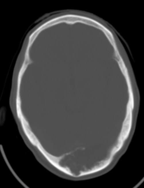 Intradiploic Epidermoid with Intracranial Extension - Sumer's Radiology ...