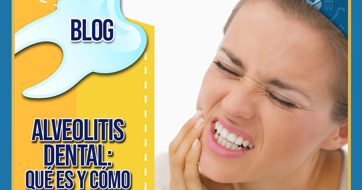 ALVEOLITIS DENTAL: ¿QUÉ ES Y CÓMO TRATARLO?