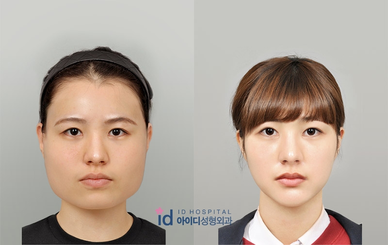 ID Hospital Korea: [ID Hospital In The News] The Secret to an Ideal V ...