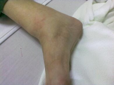 Caring Is Not Only Sharing...: Broken And Dislocated Ankle