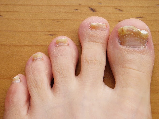 Home Remedies to Cure Toenail Fungus Fast