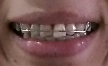 What is it like to wear a retainer? ~ Just My Lil' Organic Life