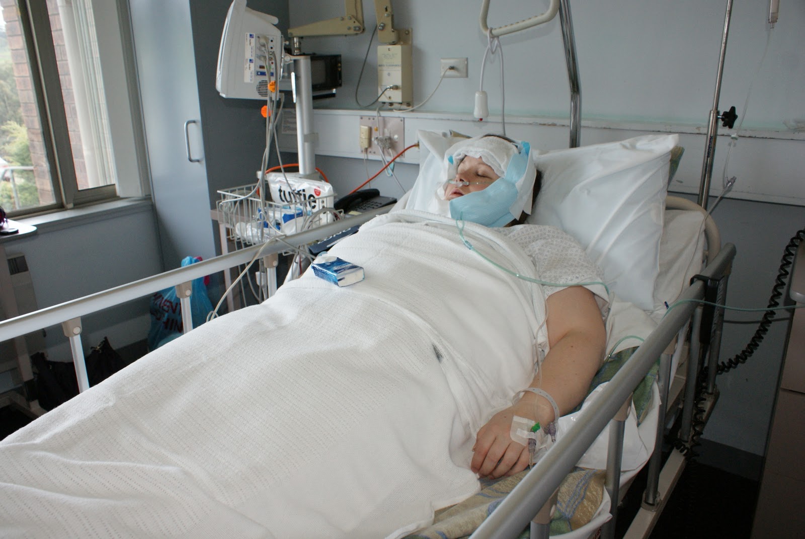 Braces + SARPE/SARME Surgery: SARPE/SARME Surgery