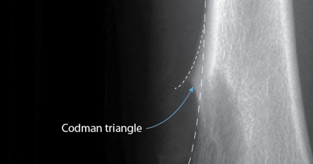 Epónimos: Triángulo de Codman