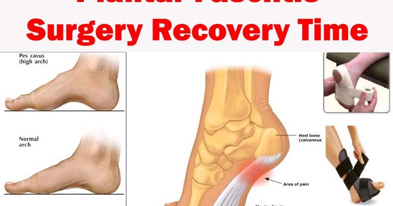 Fast and effective solution for painful heels: Plantar Fasciitis ... Fast and effective solution for painful heels: Plantar Fasciitis ...