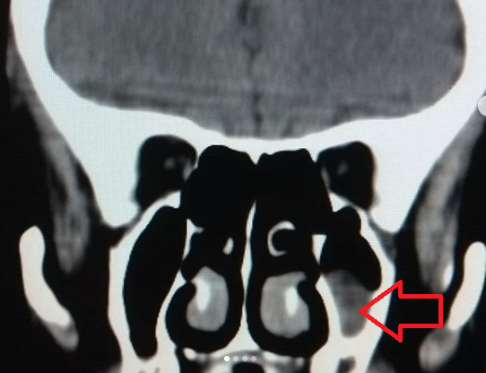 DICAS DE RADIOLOGIA - Tudo Sobre Radiologia: RAIO X SEIOS DA FACE OU ...