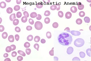 Macrocytic Anemia - Megaloblastic Anemia